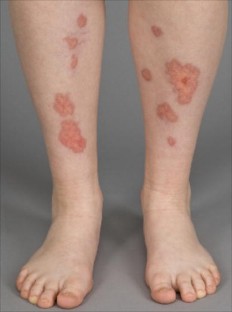 Cutaneous Manifestations of Diabetes Mellitus: A Review | SpringerLink