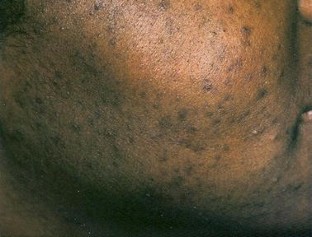 Postinflammatory Hyperpigmentation: Epidemiology, Clinical Presentation ...