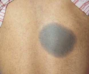 Fixed Drug Eruptions: An Update, Emphasizing the Potentially Lethal ...