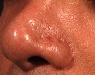 Dermatologic Laser Side Effects and Complications: Prevention and ...