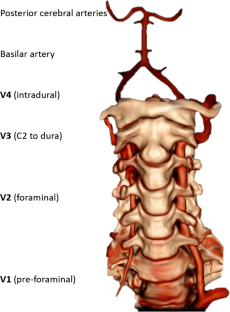 Vertebral Artery Dissection in Sport: A Systematic Review | SpringerLink