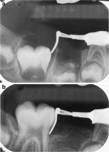 Optimal fit of chairside-fabricated distal shoe space maintainer ...
