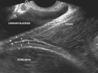 Scar thickness measurement by transvaginal sonography in late second ...