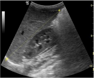 Paediatric liver ultrasound: a pictorial essay | SpringerLink