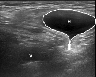 Sonographic “speech bubble/speech box sign” in clinically occult ...