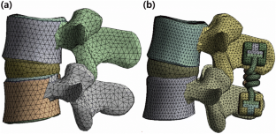 Design of a Lumbar Interspinous Fixation Device for Minimally Invasive ...