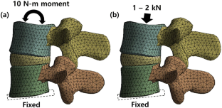 Design of a Lumbar Interspinous Fixation Device for Minimally Invasive ...