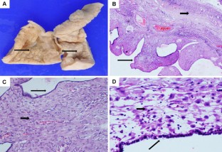 Cystadenofibroma: A Benign Epithelial Ovarian Tumor in Pregnancy ...