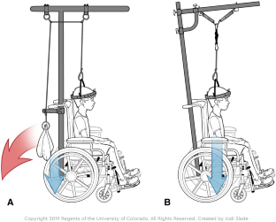 Development of a spring-based weight system for halo gravity traction ...