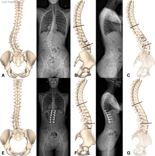 Three-dimensional analysis of the sagittal profile in surgically ...