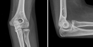 Usefulness of the Sauvegrain Method of Bone Age Assessment in Indian ...