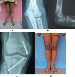 Usefulness of the Sauvegrain Method of Bone Age Assessment in Indian ...