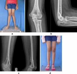 Usefulness of the Sauvegrain Method of Bone Age Assessment in Indian ...