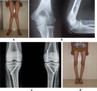 Usefulness of the Sauvegrain Method of Bone Age Assessment in Indian ...