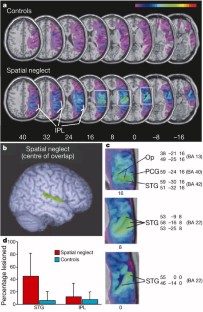 Spatial awareness is a function of the temporal not the posterior ...