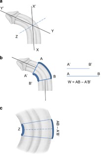 Geometrical modified nesbit corporoplasty to correct different types of ...
