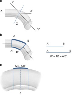 Geometrical modified nesbit corporoplasty to correct different types of ...