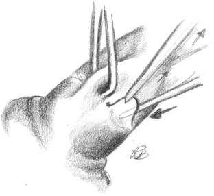 Geometrical modified nesbit corporoplasty to correct different types of ...