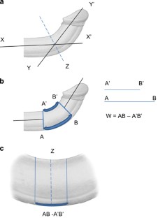Geometrical modified nesbit corporoplasty to correct different types of ...