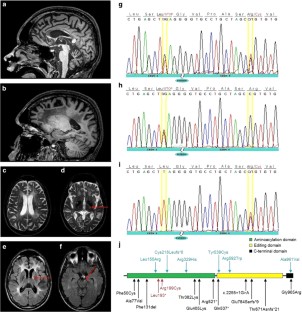 Novel AARS2 gene mutation producing leukodystrophy: a case report ...