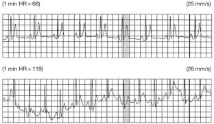 Short QT syndrome: mechanisms, diagnosis and treatment | Nature Reviews ...