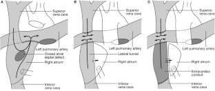 The Fontan circulation: a challenge to William Harvey? | Nature Reviews ...