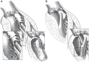 Surgery Insight: septal myectomy for obstructive hypertrophic ...