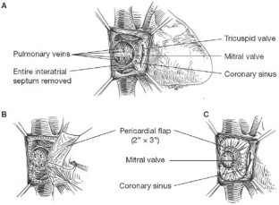 Evaluation and management of the adult patient with transposition of ...