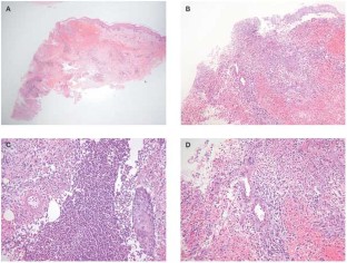 Therapy Insight: pyoderma gangrenosum—old disease, new management ...