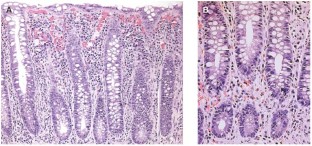 Drug-induced injury in the gastrointestinal tract: clinical and ...