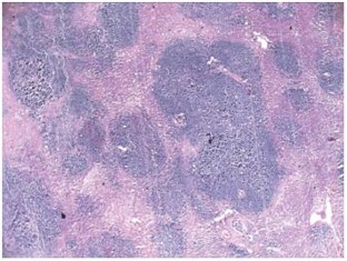 Diffuse malignant infiltration of the liver manifesting as a case of ...