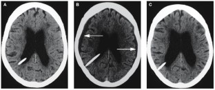 The diagnosis and treatment of idiopathic normal pressure hydrocephalus ...