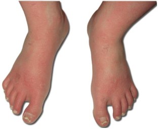 A case of inherited erythromelalgia | Nature Reviews Neurology