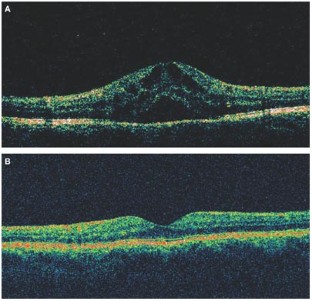 Severe uveitis in an HLA-B27-positive patient with ankylosing ...