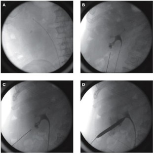 A case of a lower pole renal calculus managed with percutaneous ...
