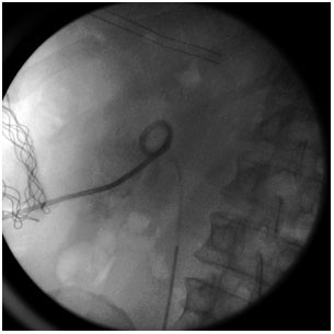 A case of a lower pole renal calculus managed with percutaneous ...
