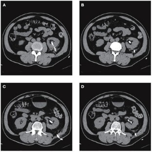 A case of a lower pole renal calculus managed with percutaneous ...