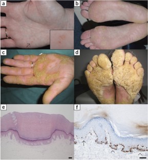 Haploinsufficiency for AAGAB causes clinically heterogeneous forms of ...
