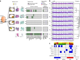 Spatial genomic heterogeneity within localized, multifocal prostate ...