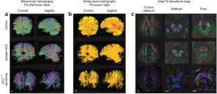 Biallelic mutations in human DCC cause developmental split-brain ...