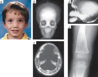 Heterozygous mutations in ANKH , the human ortholog of the mouse ...