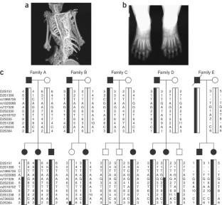 A recurrent mutation in the BMP type I receptor ACVR1 causes inherited ...