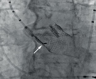 New devices for TAVI: technologies and initial clinical experiences ...