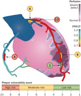 Comprehensive plaque assessment by coronary CT angiography | Nature ...