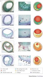 Pathophysiology of native coronary, vein graft, and in-stent ...