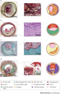 Pathophysiology of native coronary, vein graft, and in-stent ...