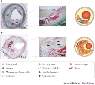 Pathophysiology of native coronary, vein graft, and in-stent ...