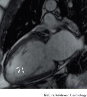 Left ventricular noncompaction cardiomyopathy: cardiac, neuromuscular ...