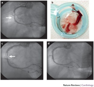 Thrombus aspiration in acute myocardial infarction | Nature Reviews ...