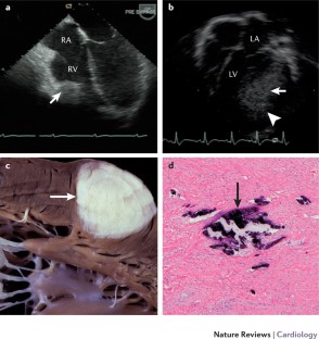 Pathology, imaging, and treatment of cardiac tumours | Nature Reviews ...
